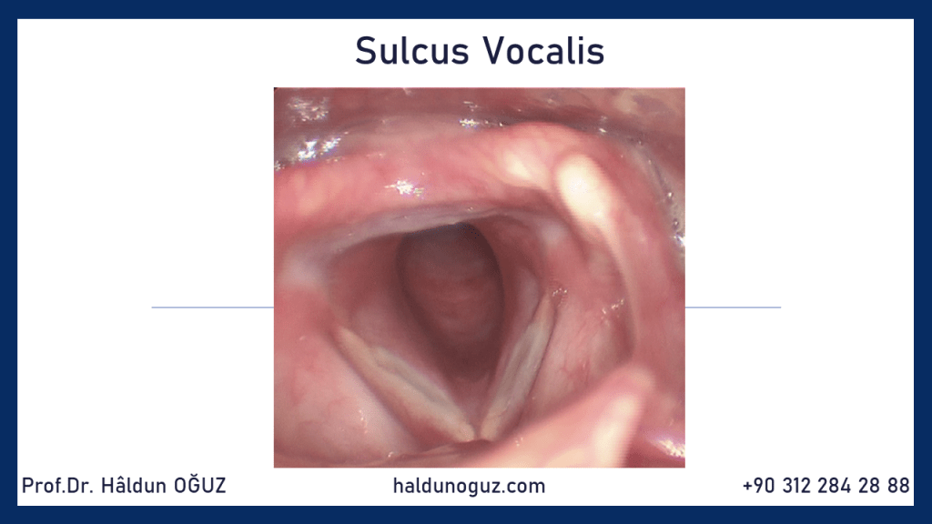 Sulcus Vocalis - Otorhinolaryngology Voice Diseases